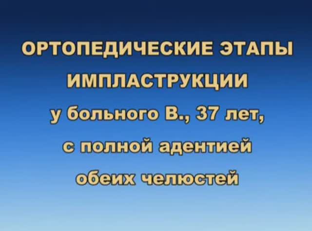 Протезирование зубов на имплантатах при полной вторичной адентии обеих челюстей