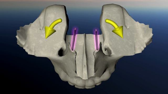 Верхняя челюсть (Максилла). Видео 2