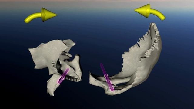 СБС. Дисфункция: Экстензиальное нарушение