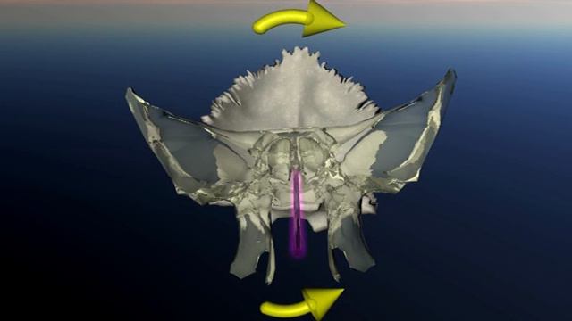 СБС. Дисфункция: Левая Торсия