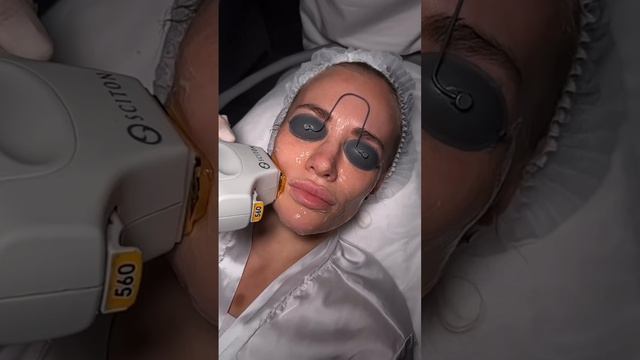 Мгновенное омоложение с длительным результатом: 
BBL Forever Young