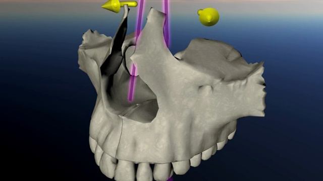 Верхняя челюсть (Максилла). Видео 1