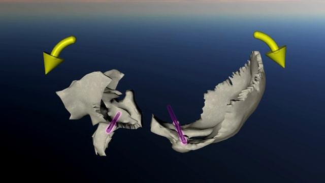 СБС. Дисфункция: Флексионное нарушение