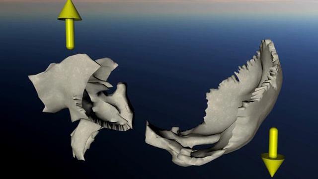 СБС. Дисфункция: Верхний Вертикальный Стрейн