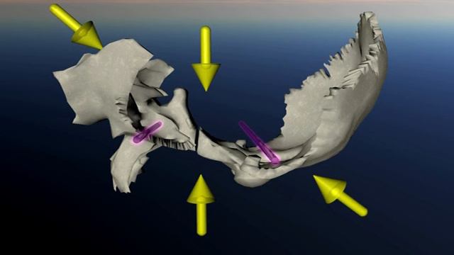 СБС. Дисфункция: Компрессия