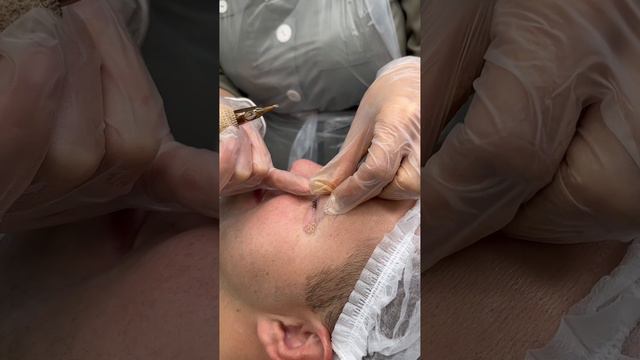 Пятна витилиго на лице | Скрыли пятна за 1 визит