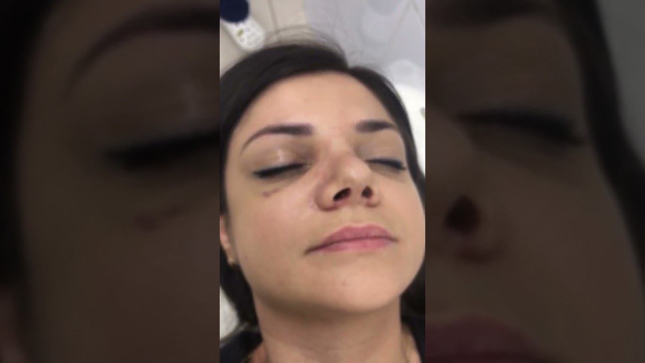 Снятие лангеты после ринопластики. Часть 2. Хирург А.А.Григорян