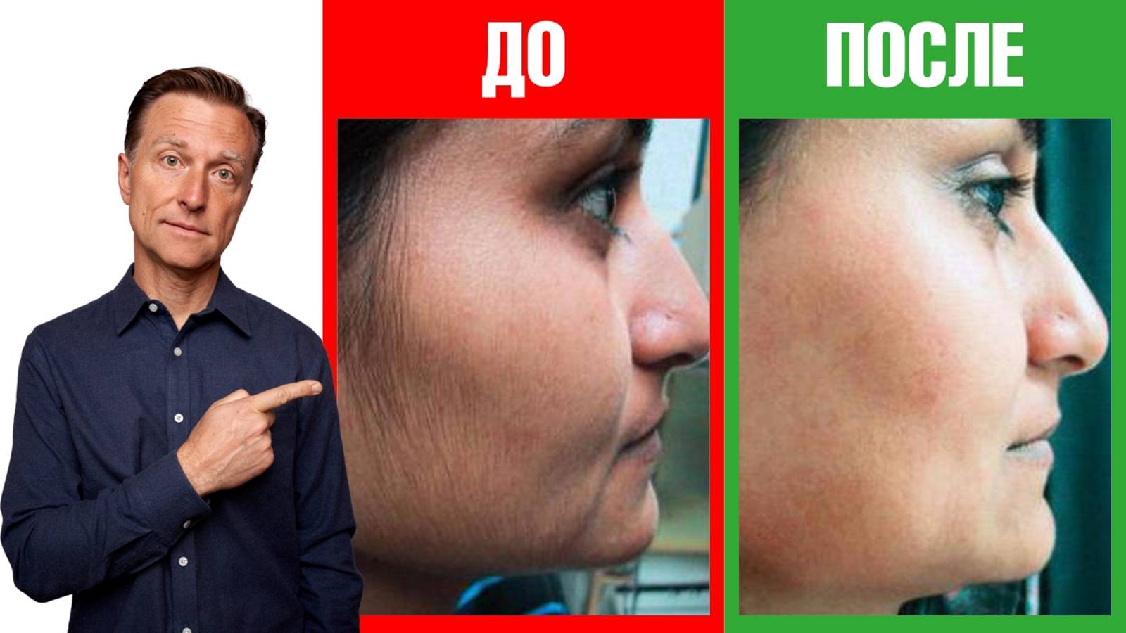 Волосы на лице женщин: главная причина. Гирсутизм и СПКЯ