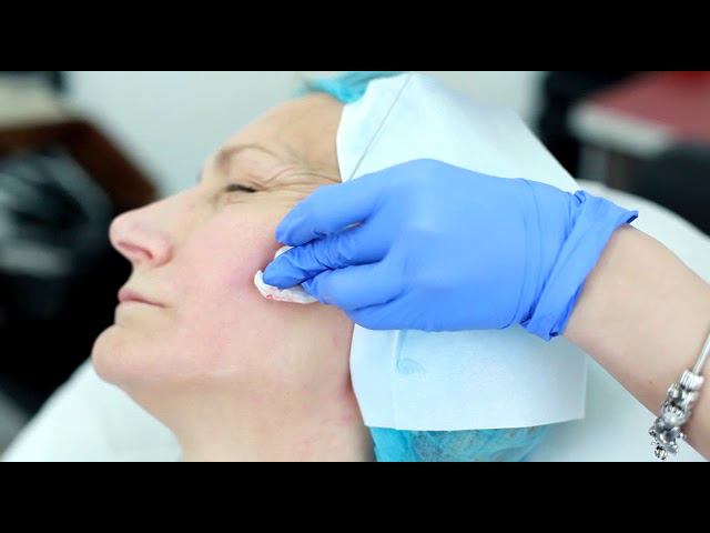 Подтяжка лица мезонитями