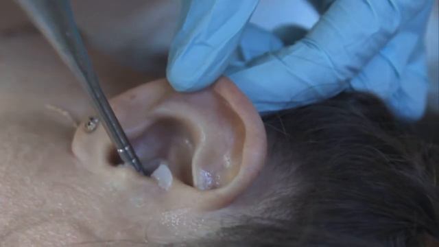 Лечение хронического наружного диффузного отита аппаратом Тонзиллор ММ