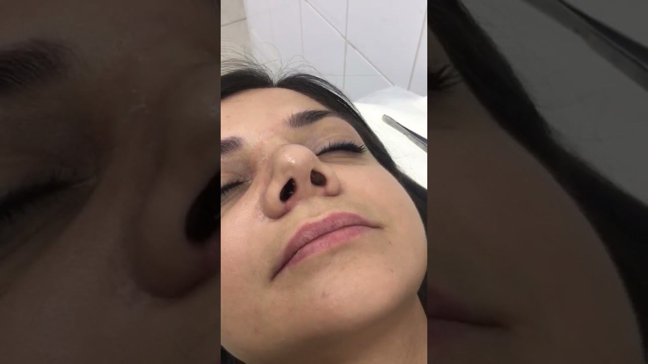 Снятие лангеты после ринопластики. Часть 1. Хирург А.А.Григорян