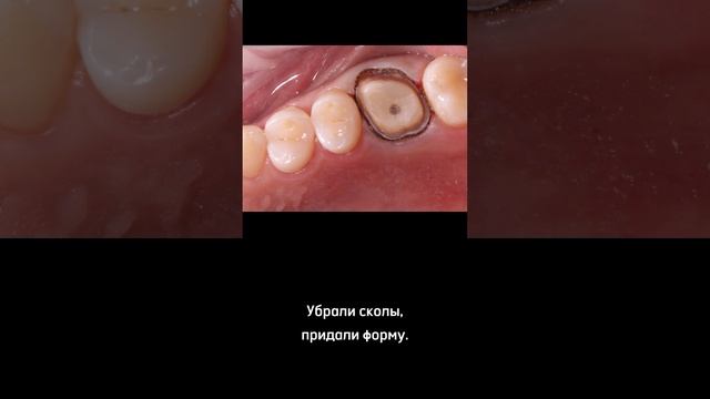Когда ставить коронки? Рекомендация стоматолога и пример работы