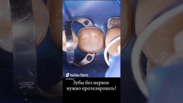 Коронка-гроб для зуба_ #клиникакозолий #стоматологияновосибирск