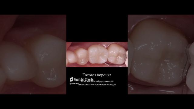 Имплантат это не «болт»: Что вы не знали о стоматологических имплантах