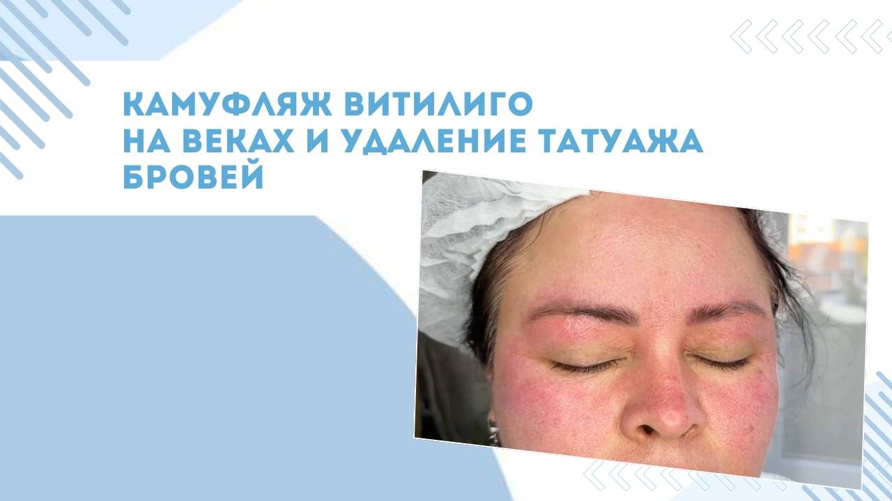 КАМУФЛЯЖ ВИТИЛИГО НА ВЕКАХ И УДАЛЕНИЕ ТАТУАЖА ЛАЗЕРОМ ЗА ОДИН ВИЗИТ