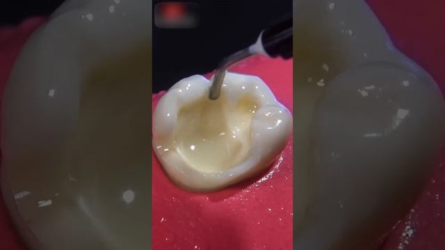 Восстановление разрушенного зуба