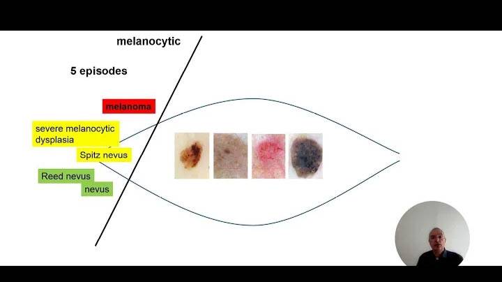 Вступление ко 2–й серии – Обзор эпизодов с 4 по 8: меланоцитарные поражения