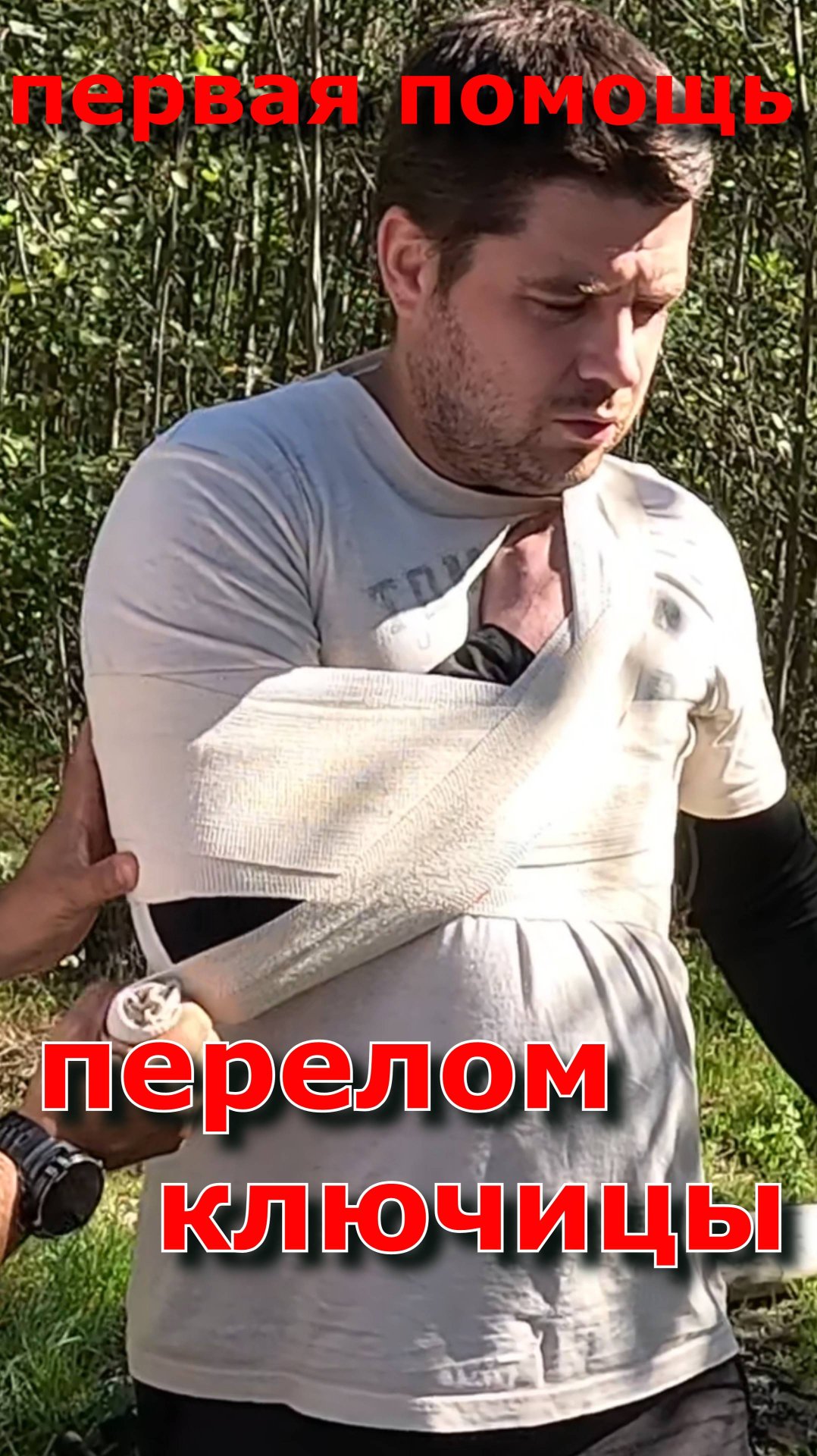 Первая помощь перелом ключицы, бинтуем, иммобилизация