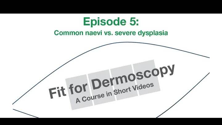 Эпизод 5 – Обычные невусы  и тяжелая дисплазия