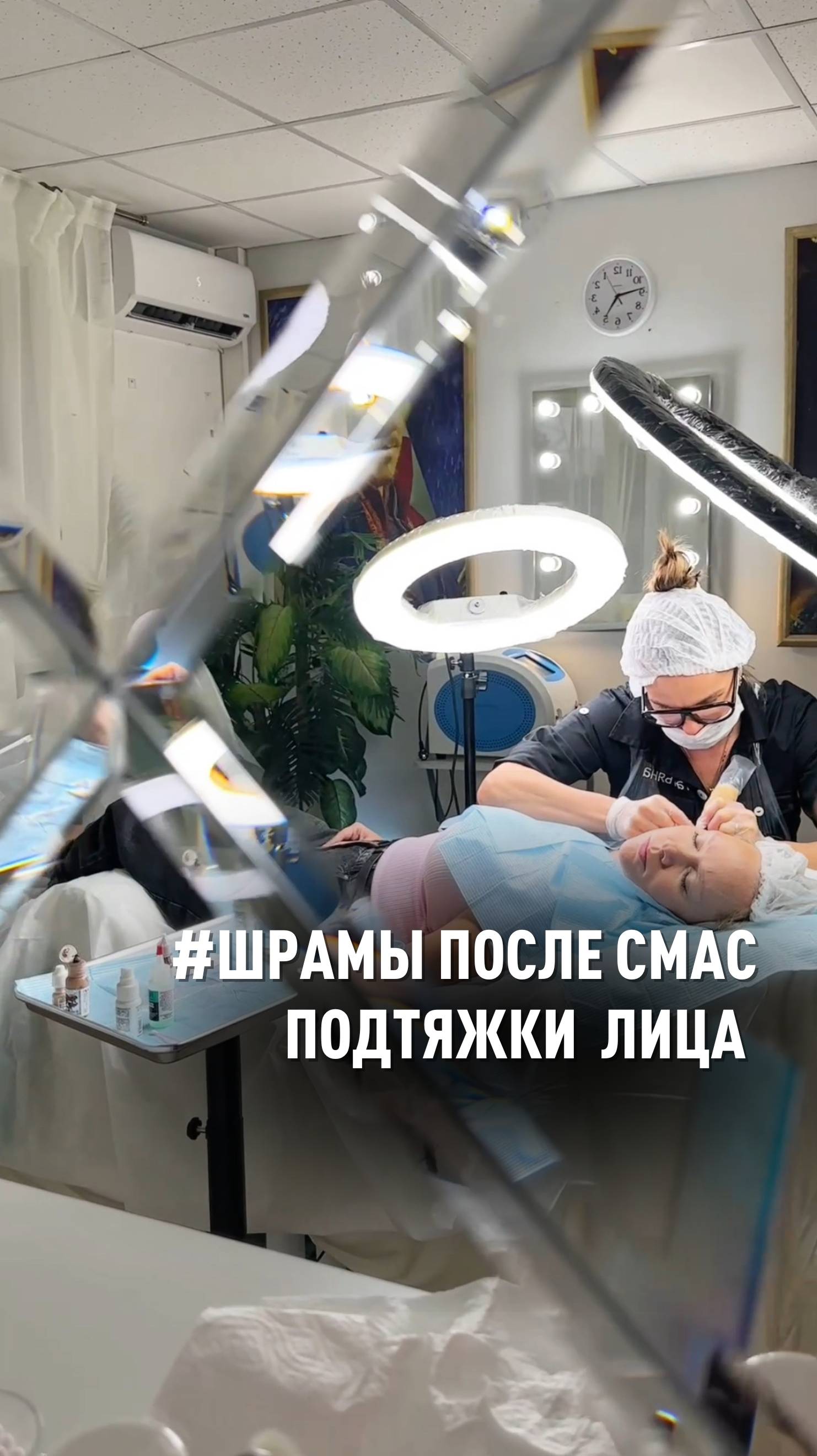 КАК УБРАТЬ ШРАМЫ ПОСЛЕ СМАС ПОДТЯЖКИ ЛИЦА?