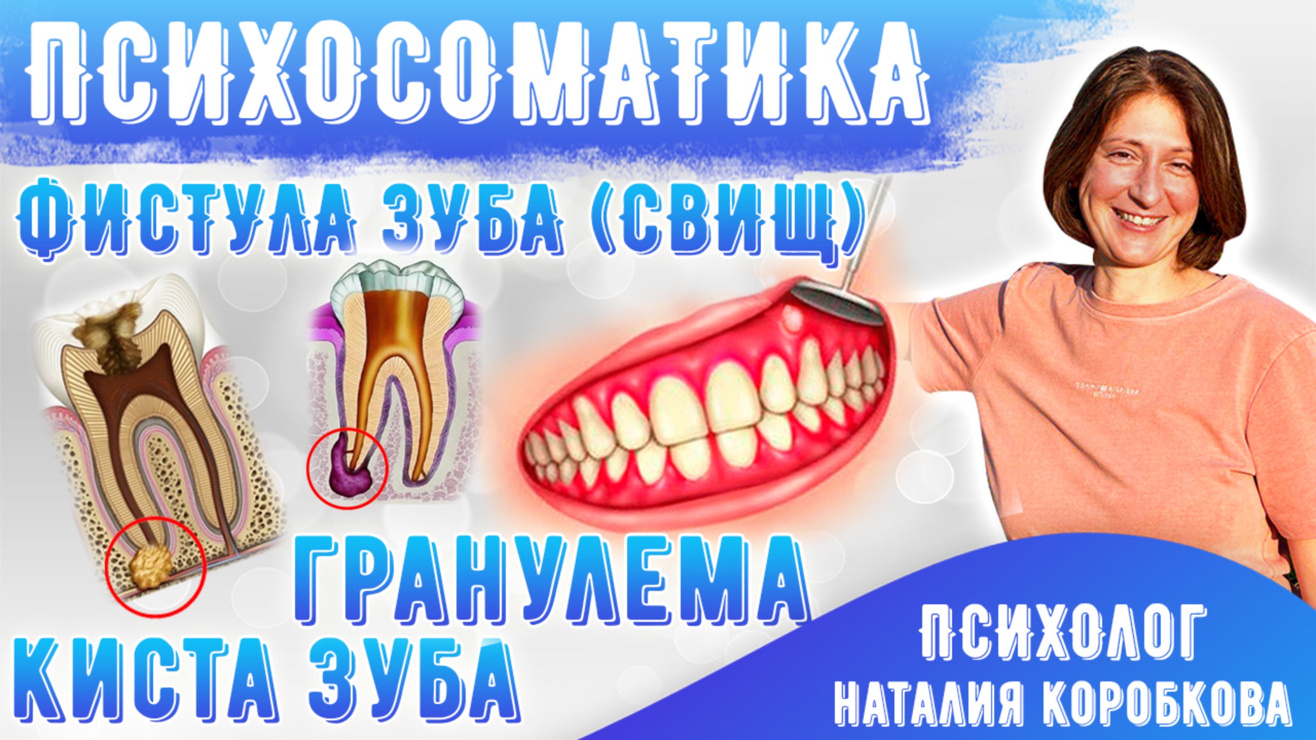 Киста зуба / Фистула / Гранулема: Психосоматика