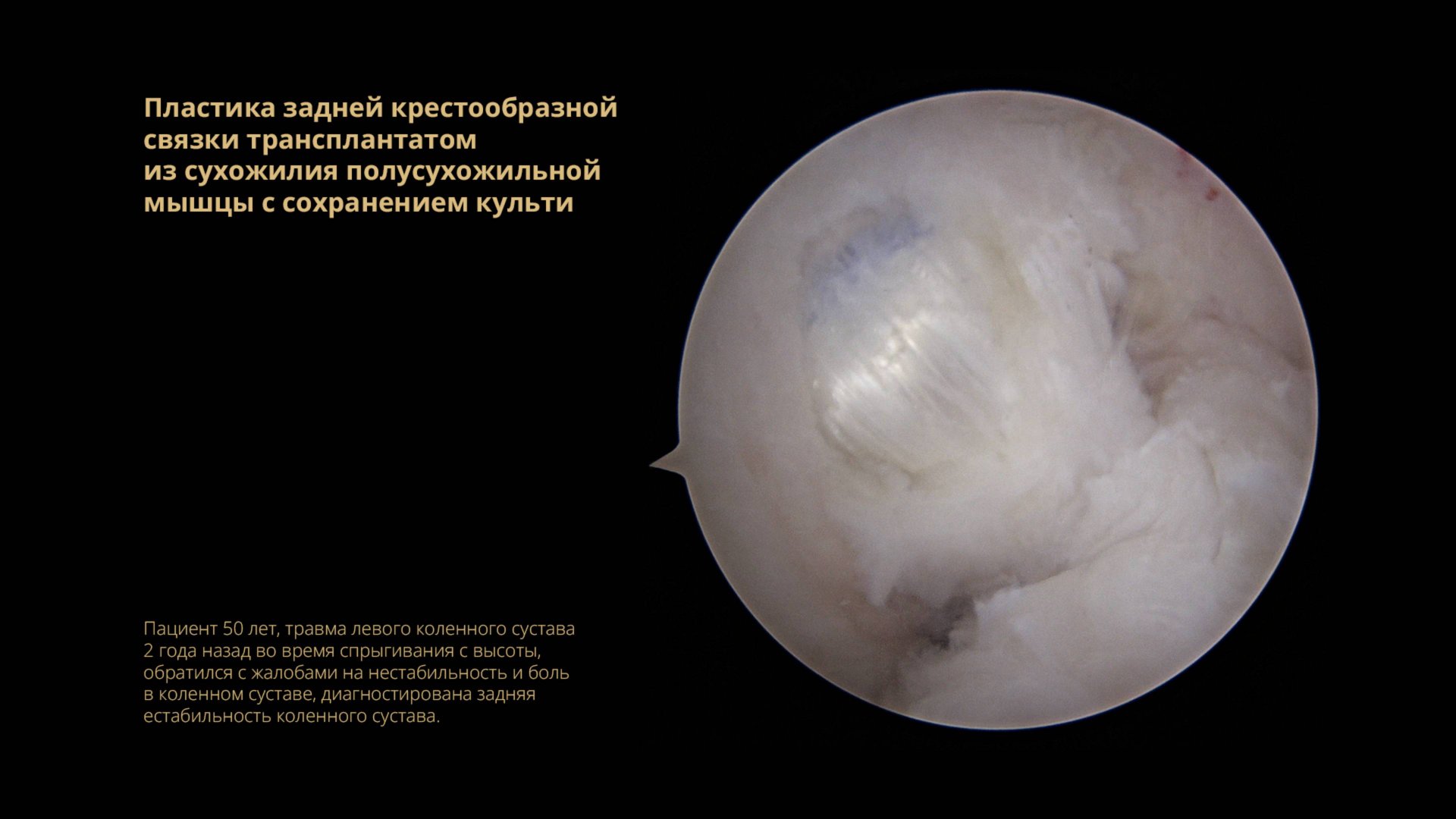 Пластика задней крестообразной связки трансплантатом из сухожилия полусухожильной мышцы