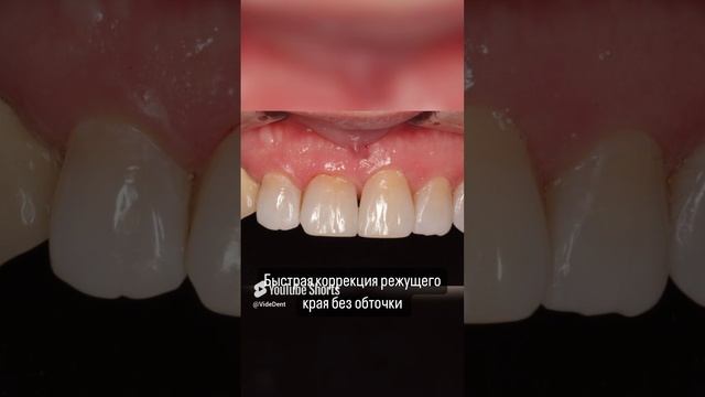 Реставрация передних зубов в Новосибирске