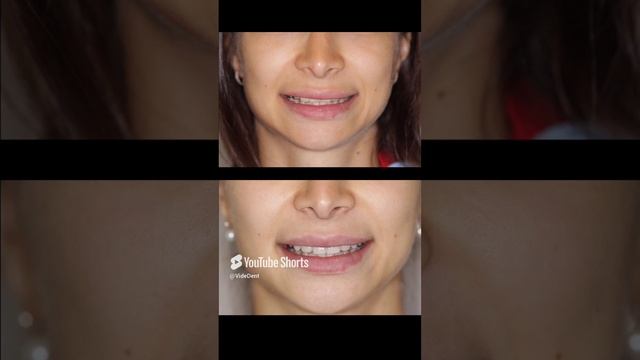 Реставрация зубов в Новосибирске - ДО_ПОСЛЕ