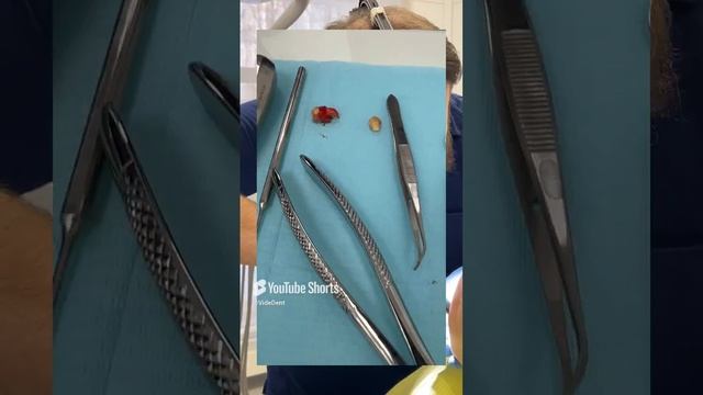 Стоматолог хирург - это весело _) Показываем часть работы!