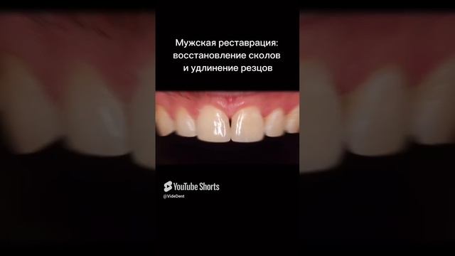 Мужская реставрация. Мужчинам тоже нужны ровные зубы! #реставрация  #реставрациязубов