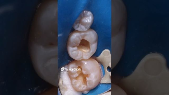 Реставрация жевательних зубов #стоматологияновосибирск  #реставрация  #реставрациязубов