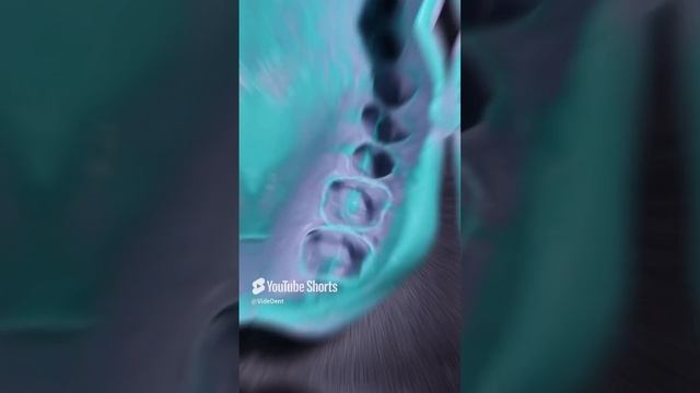 Залог идеального прилегания коронок #dentist #стоматологияновосибирск