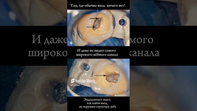 Как работать в сильно изогнутых каналах_ #клиникакозолий #стоматологияновосибирск