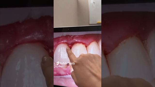 Диастема ДО_ПОСЛЕ. Закрытие диастемы Козолий ДМ. Реставрация диастемы передних зубов.