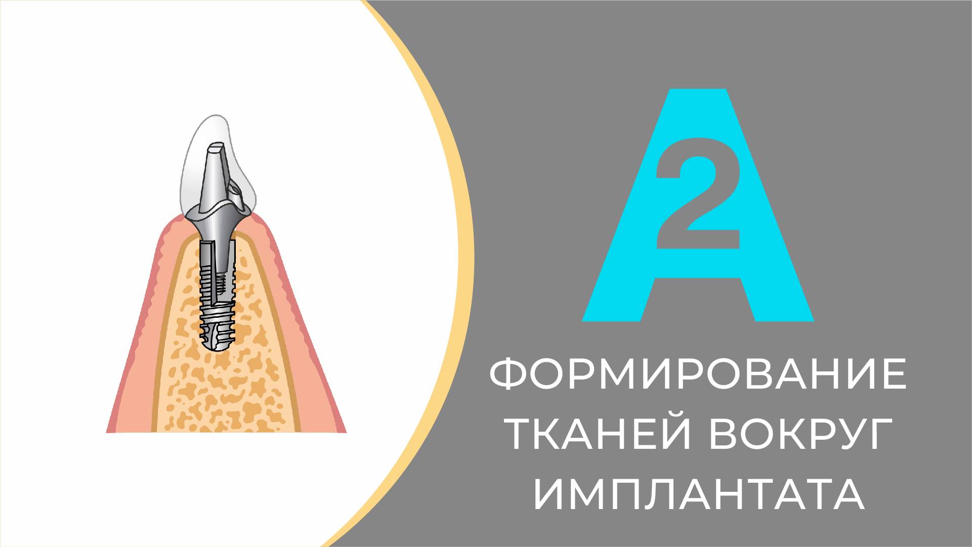 ФОРМИРОВАНИЕ ТКАНЕЙ ВОКРУГ ИМПЛАНТАТА А2