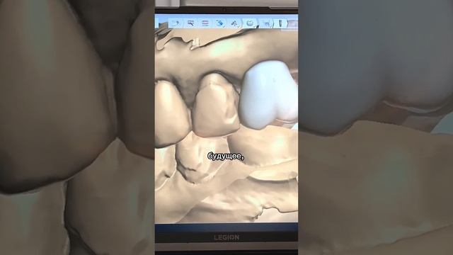 Имплантация зубов. Весь путь до установки имплантата