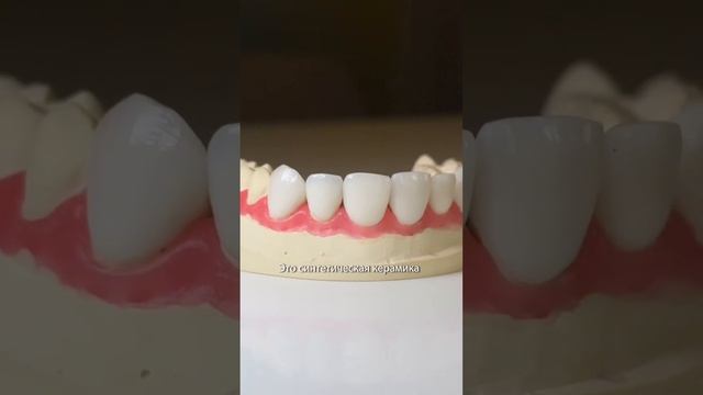 Из чего делают виниры? И какой материал лучше?