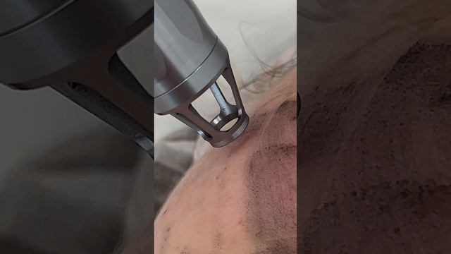 Лазерный карбоновый пилинг от расширенных пор и покраснений | клиника GEN87