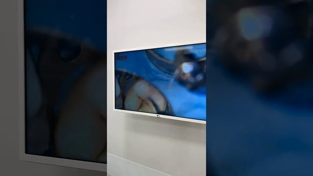  Лечение кариеса перед ортодонтическим лечением