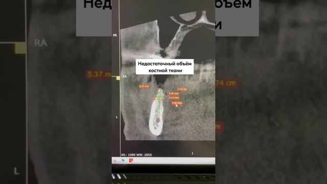 Дефицит костной ткани и имплантация