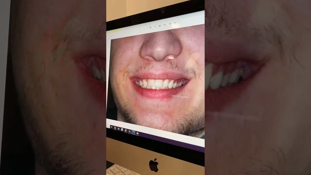 Адентия или отсутствие зубов. Клинический случай