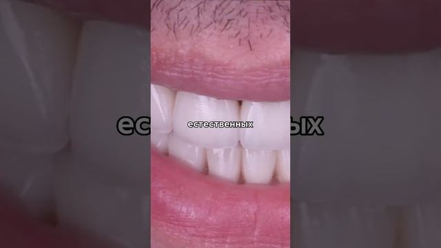 Керамические виниры. Тонкости высокой эстетики