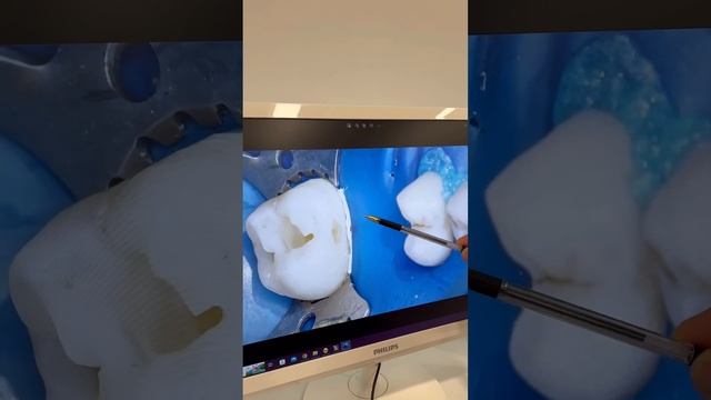 Лечение контактного кариеса. Клинический случай