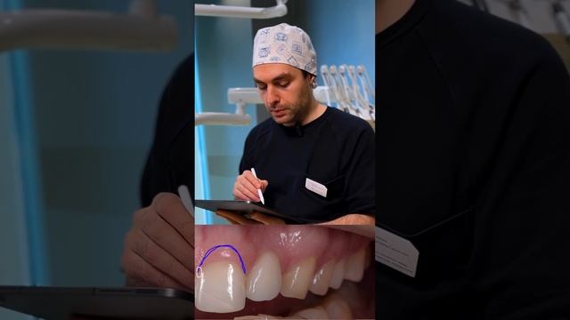 Пластика десны. Клинический случай стоматологии Belgravia Dental Studio