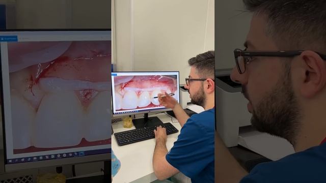 Рецессия десны. Клинический случай