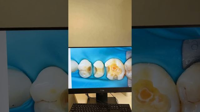 ⚕️ Почему необходимы профосмотры у стоматолога? Клинический случай