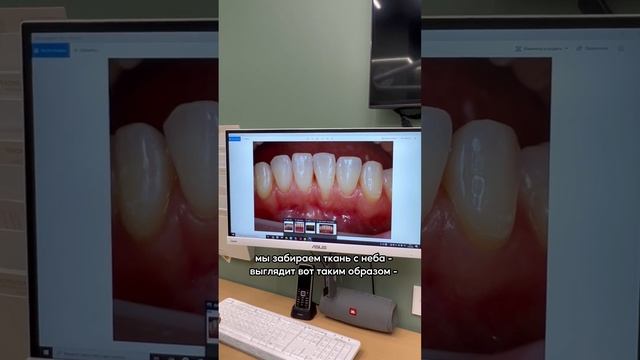 Рецессия десны - лечение. Клинический случай