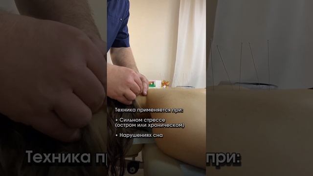 ИСПЫТЫВАЕТЕ СТРЕСС?Приглашаем Вас на иглорефлексотерапию #здоровье #массаж #калуга #massage