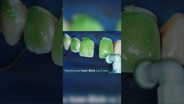 Вылечить кариес без сверления и бор-машины