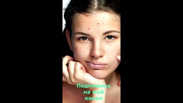 Акне! Лечение народными средствами